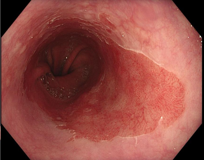 Treatment | From Gum To Bum